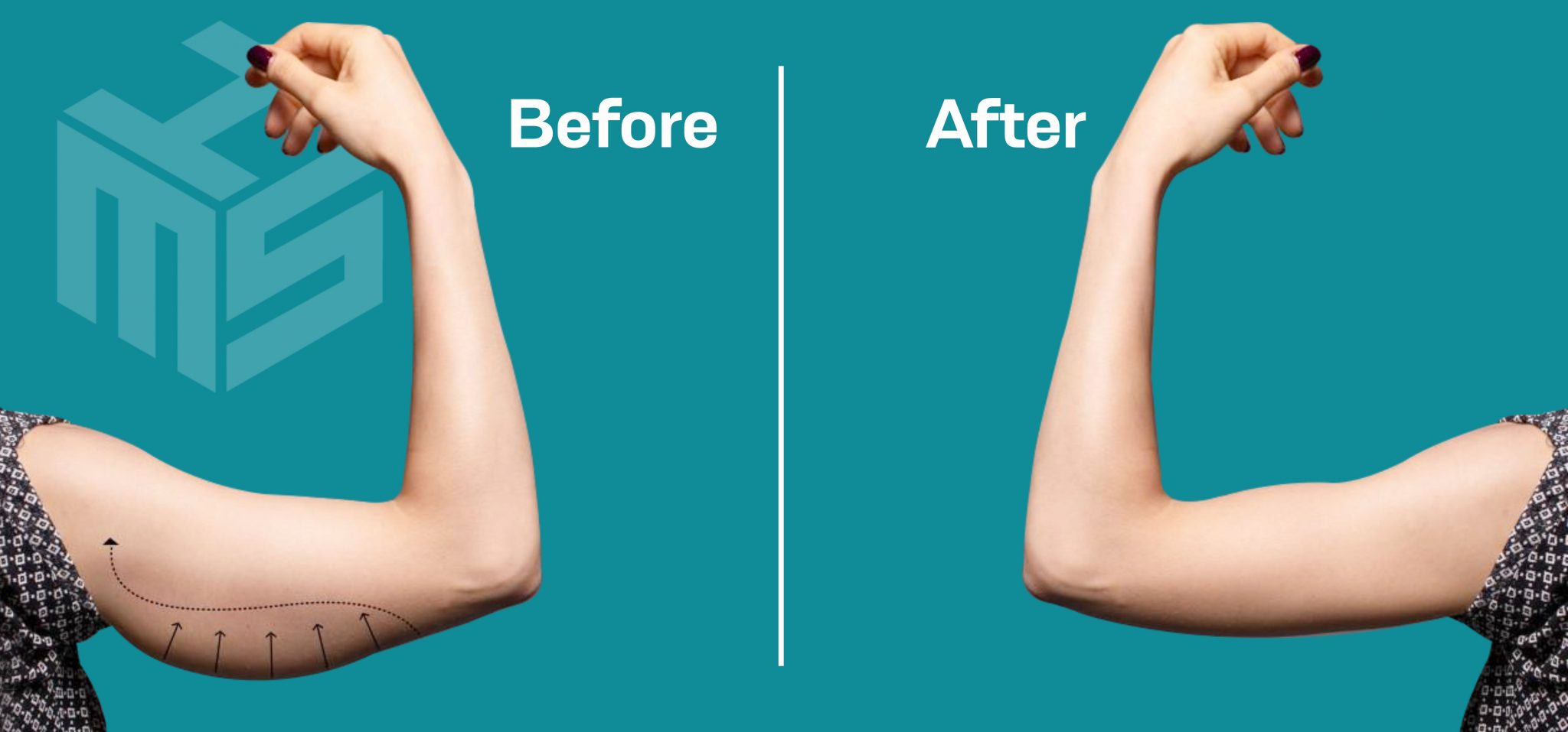 Velashape iii - HMS Fat Freezing